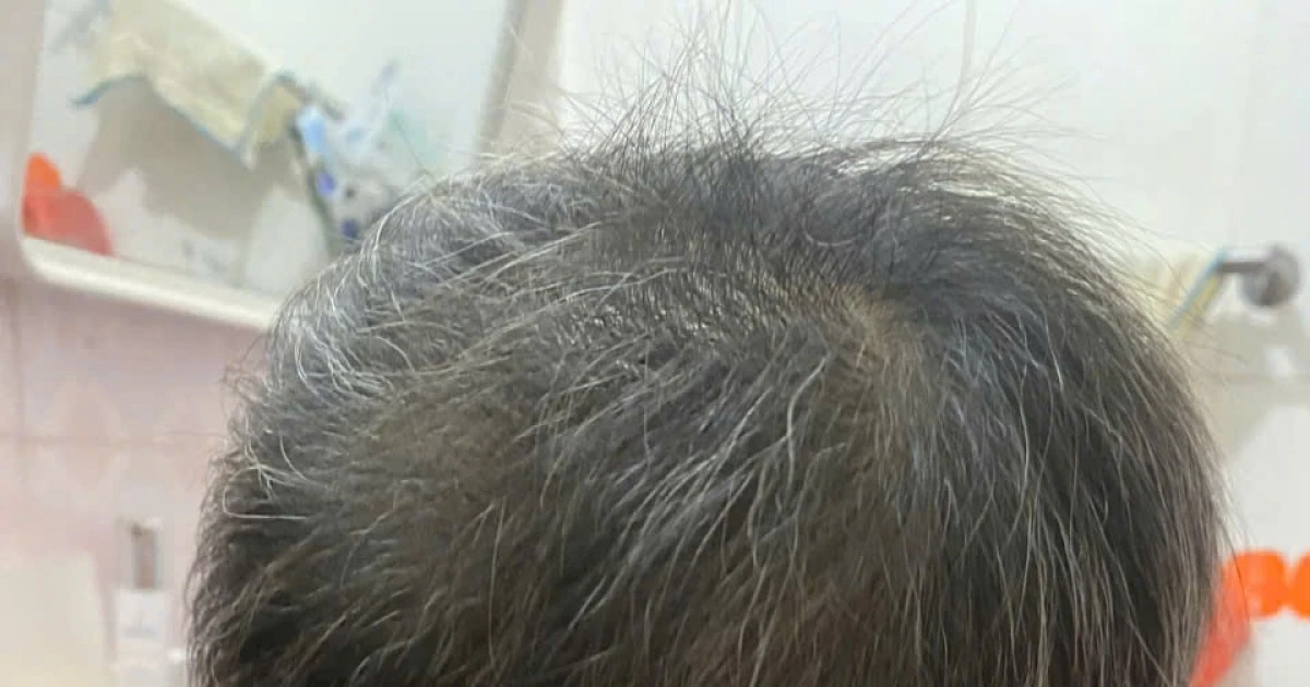 Trẻ 7 tuổi rụng trọc tóc vì bệnh tự miễn, thuốc ức chế Janus kinase ...