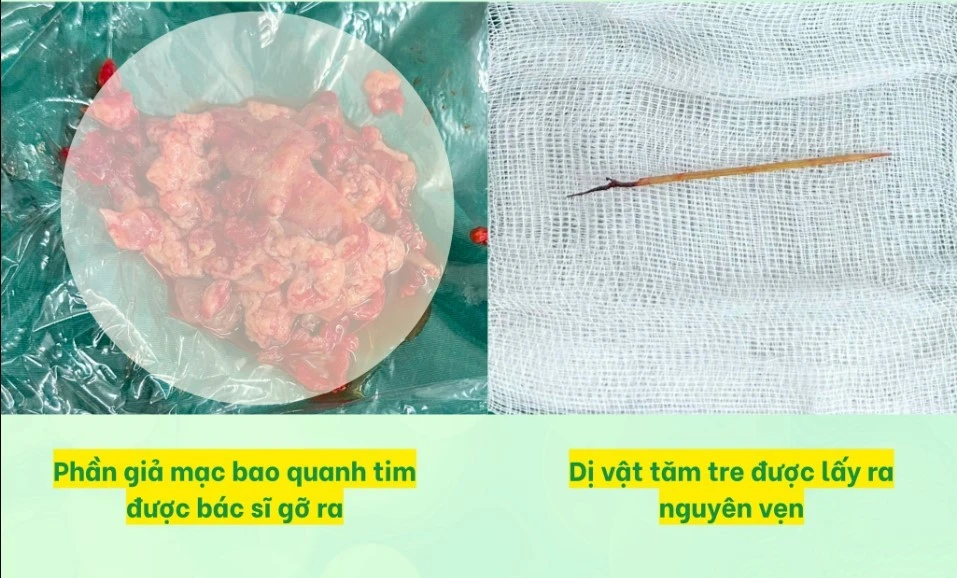 Hy hữu: mổ cấp cứu tràn mủ màng tim, phát hiện tăm tre xuyên thất phải