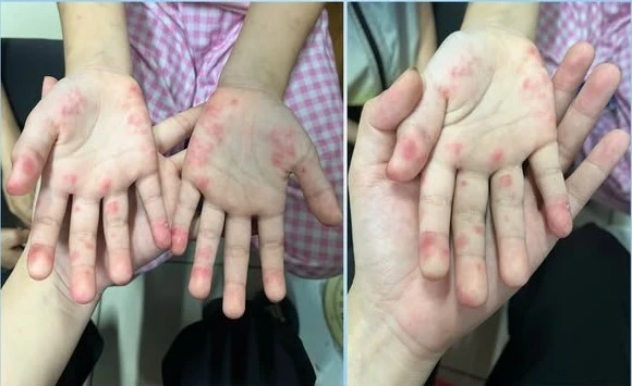Nổi ban đỏ trên da đi khám nhiều nơi mới phát hiện lupus ban đỏ
