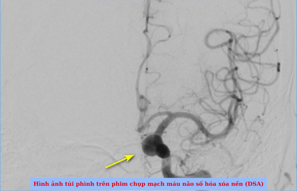 Stent chuyển dòng cứu người bệnh 50 tuổi bị phình lớn mạch máu não