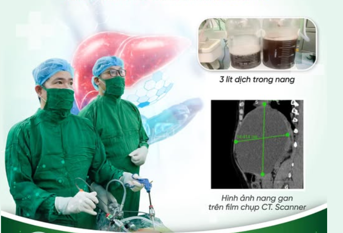 Hút hơn 3 lít dịch từ nang gan lành tính