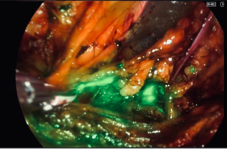 Ứng dụng kỹ thuật mới điều trị ung thư nội mạc tử cung tại Bệnh viện K